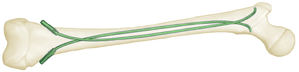 Paediatric Elastic Nails | Austofix