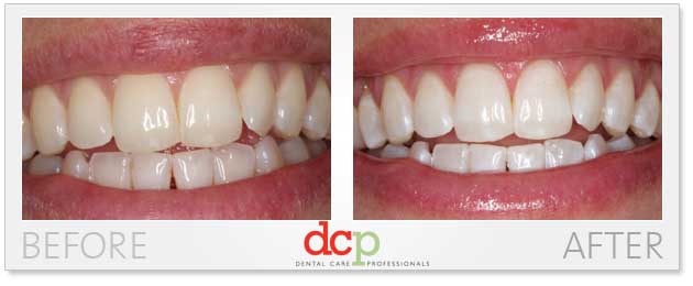 Teeth Whitening Treatments Adelaide & Brighton | No.1 Dentistry