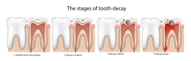 Common Causes of Tooth Decay | Dental Care Professionals