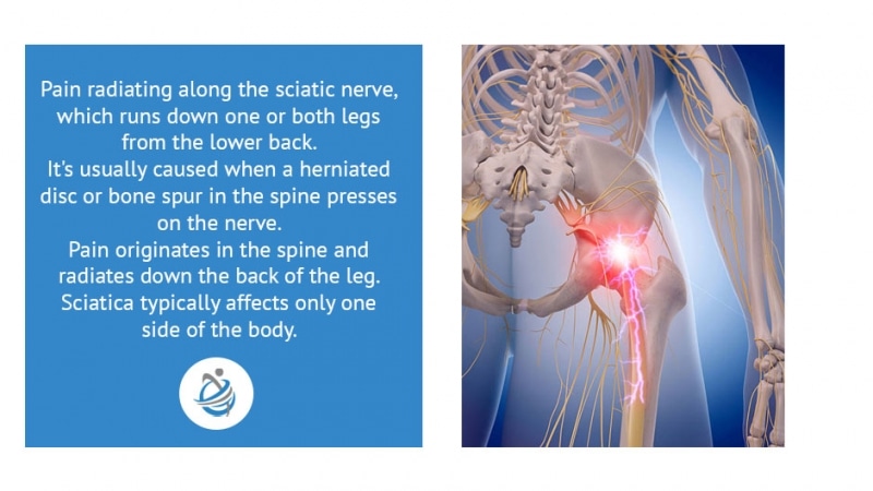 Sciatica! A Pain In The Bum! Literally. - Equilibrium Sports and Spinal ...