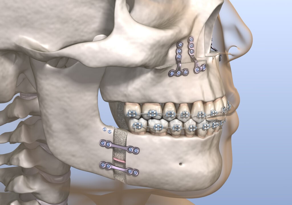 Corrective Jaw Surgery - An Overview