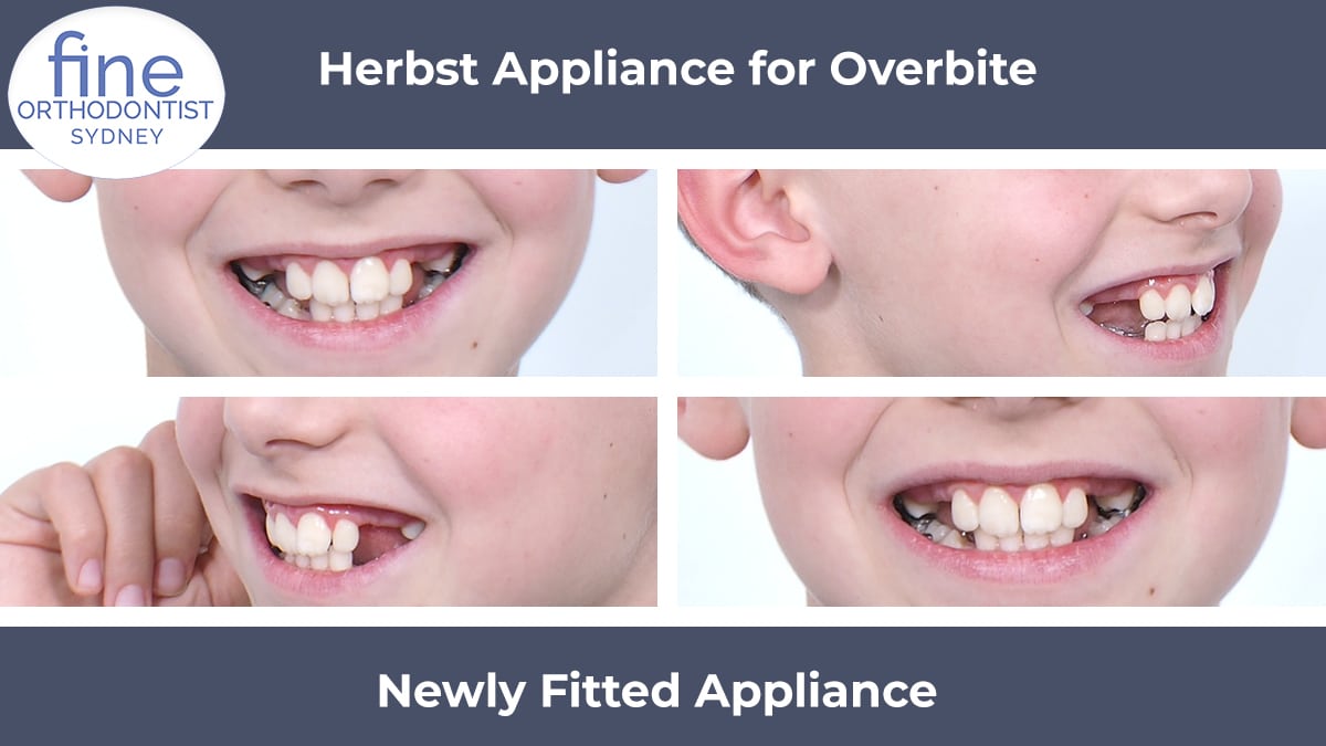 Orthodontic Appliances - Fine Orthodontist Sydney