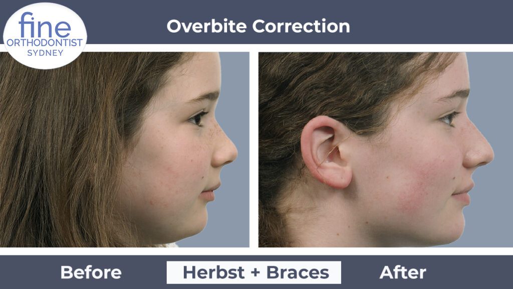 Before and After Herbst Appliance - Fine Orthodontist Sydney