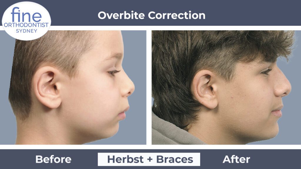 Before and After Herbst Appliance - Fine Orthodontist Sydney