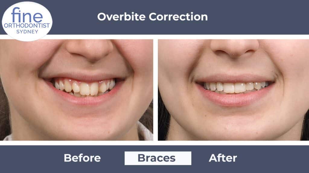 Overbite Before And After Pictures Orthodontic Before After Photos