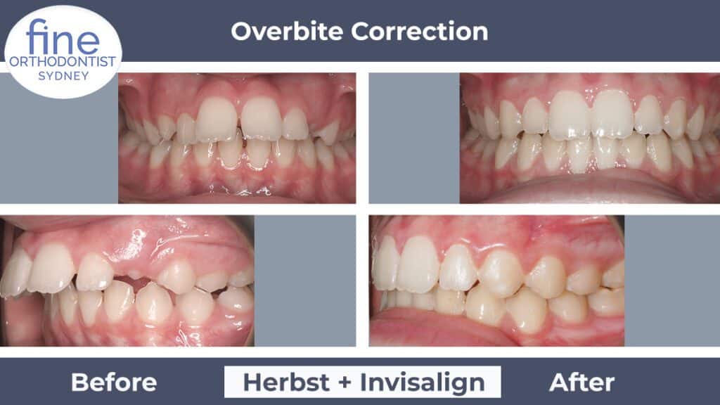 Before and After Herbst Appliance - Fine Orthodontist Sydney