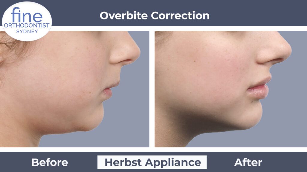 Before and After Herbst Appliance - Fine Orthodontist Sydney
