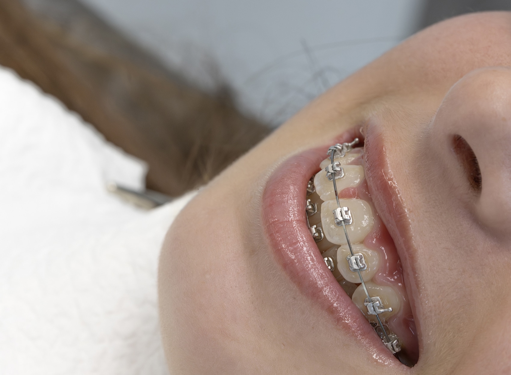 Braces - Fine Orthodontist Sydney