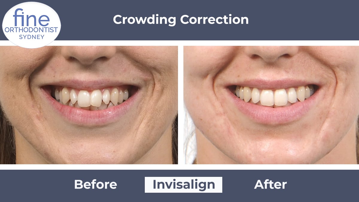 Crooked Teeth Before And After Invisalign