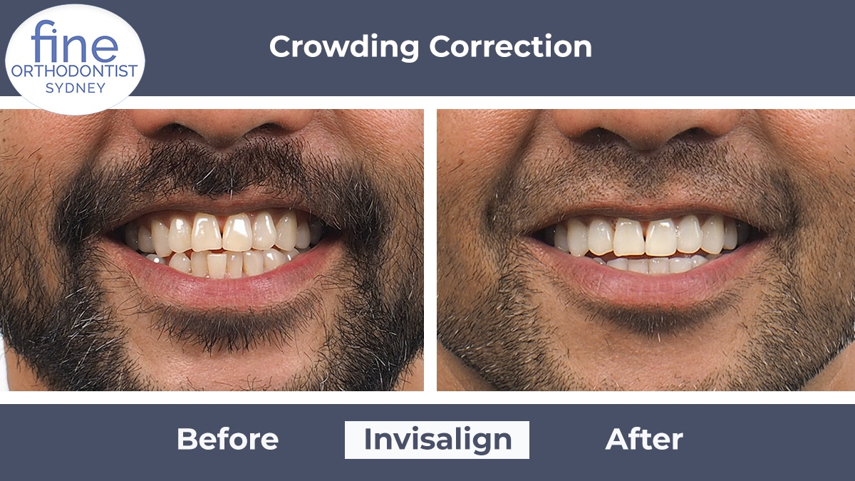 Before and After Invisalign - Fine Orthodontist Sydney