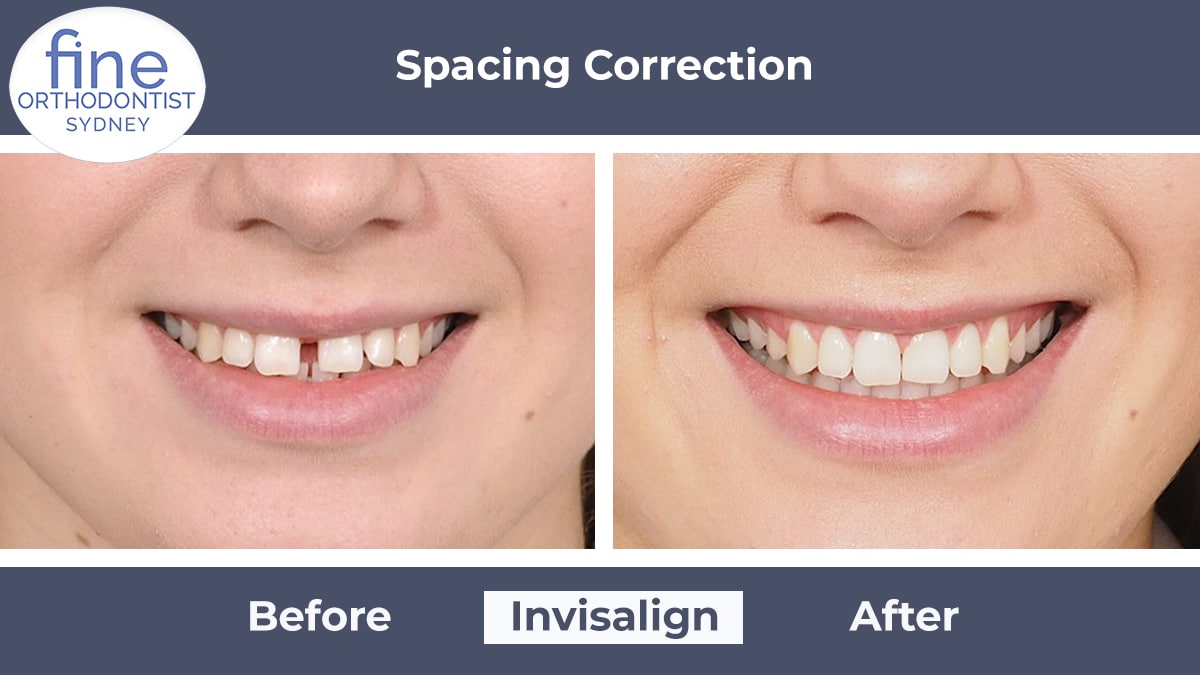 Before and After Invisalign - Fine Orthodontist Sydney