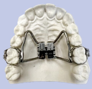 Orthodontic Expanders: An Overview