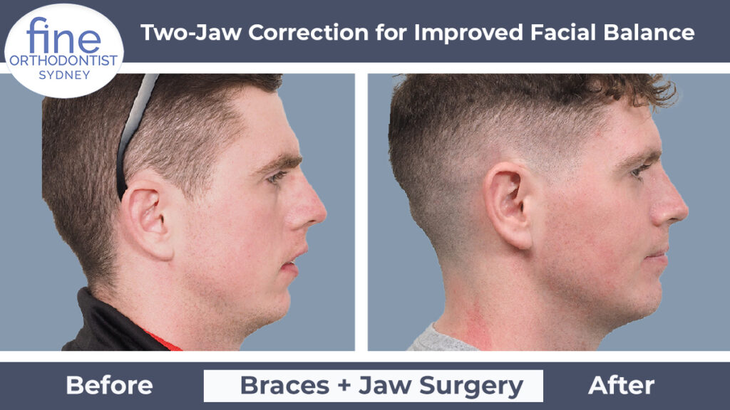 Before and After Jaw Surgery - Fine Orthodontist Sydney