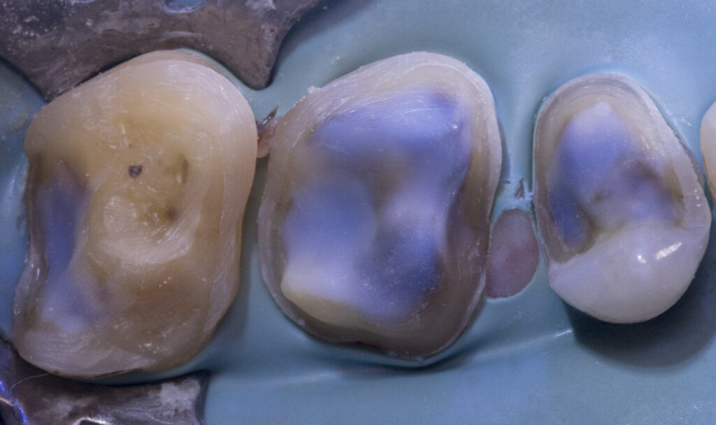 Mercury Amalgam Removal - Heal Dental Care