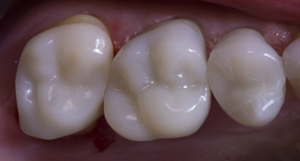 Mercury Amalgam Removal - Heal Dental Care