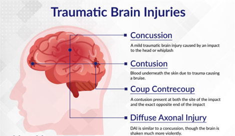 Exercise & Traumatic Brain Injury (TBI) | Inertia Health Group Adelaide