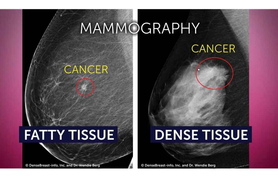 The global breast density conversation: Meet one woman driving change ...