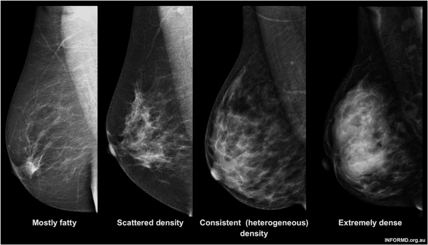 Information Forum on Mammographic Density | Breast Density